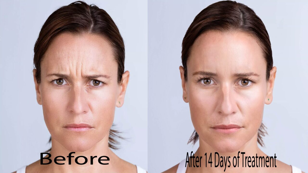 Cosmetic Injections | Belfiore Wellness Center and Gynecology